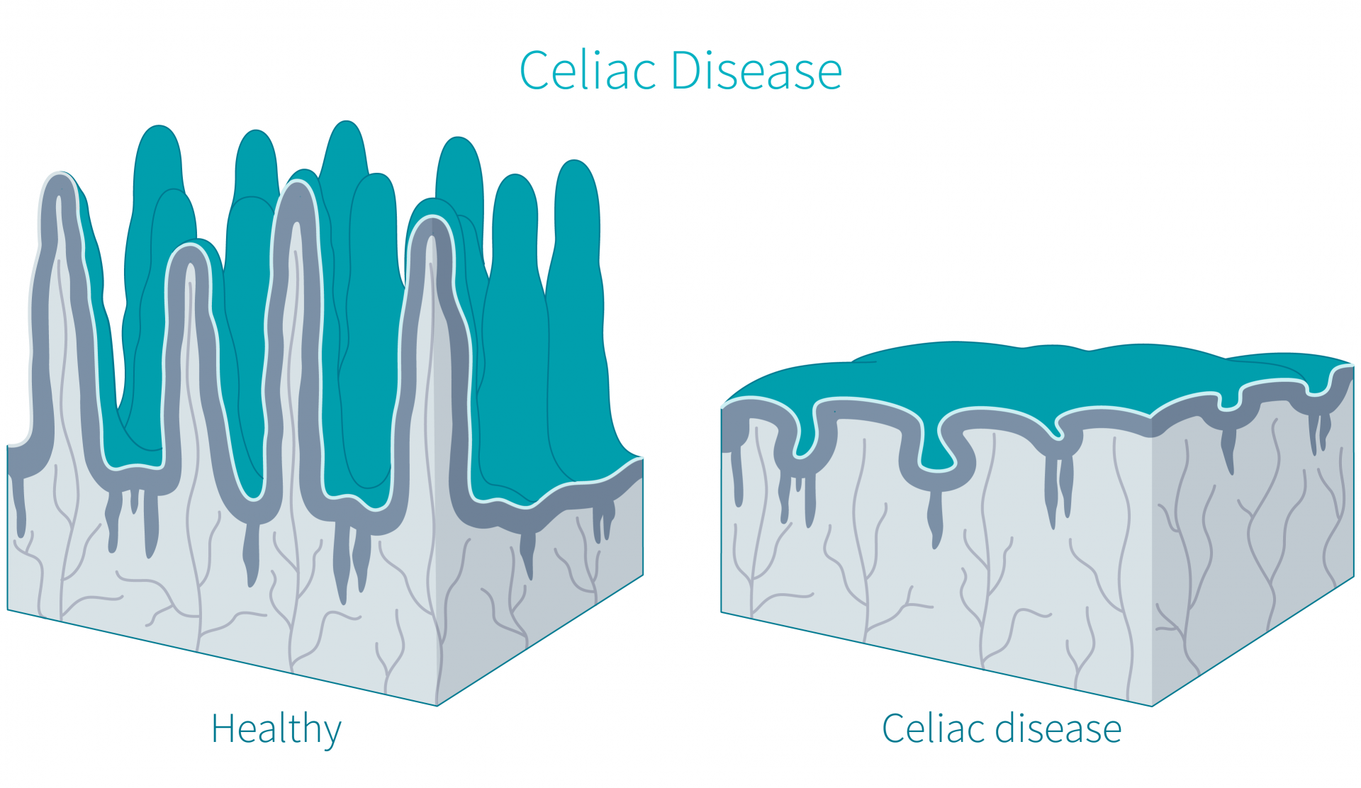 Celiac Disease: How to Eat Out and Not Get in Trouble - Health Care Reform