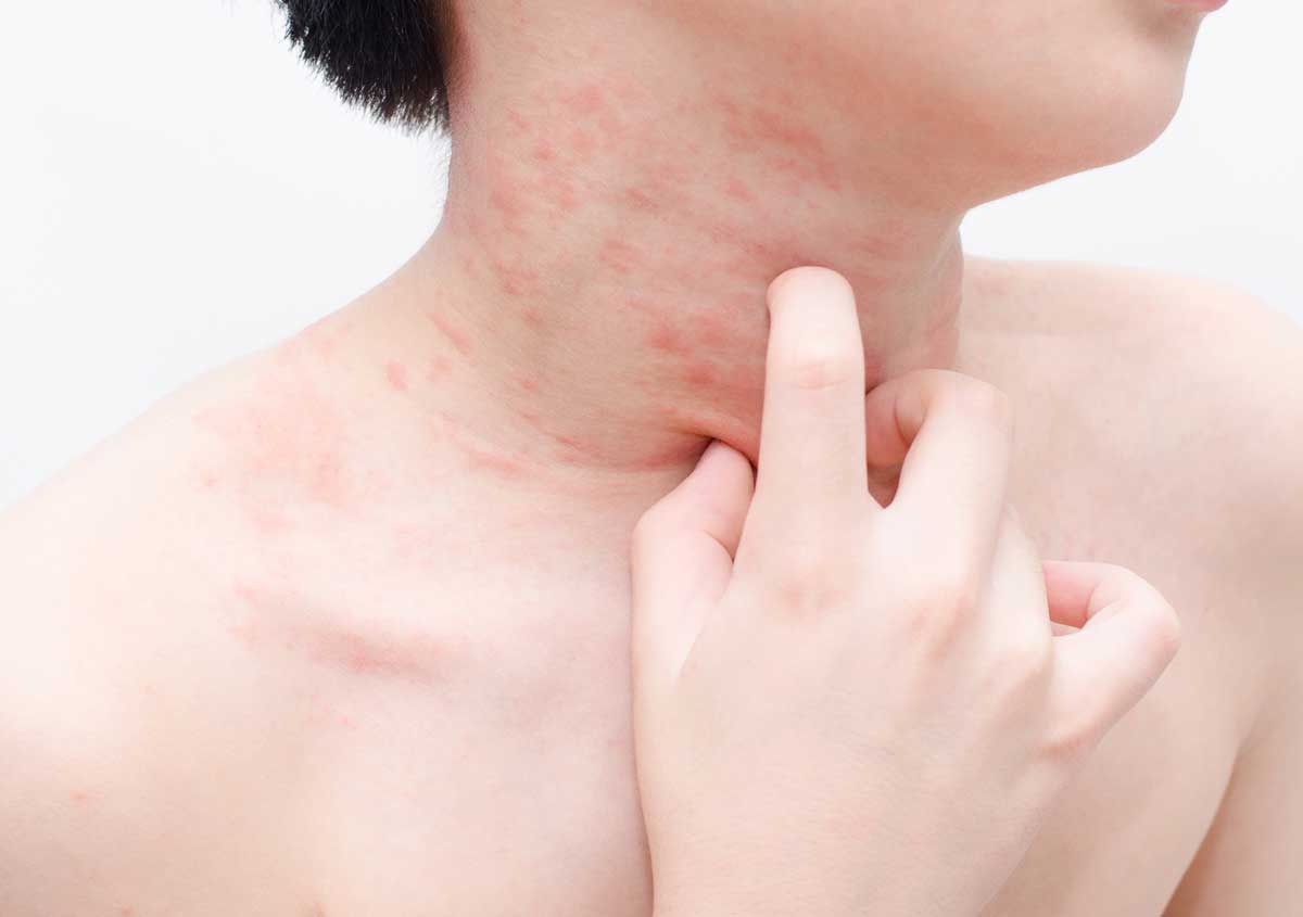 How Do You Prepare Food Safely For Someone With A Food Allergy ...
