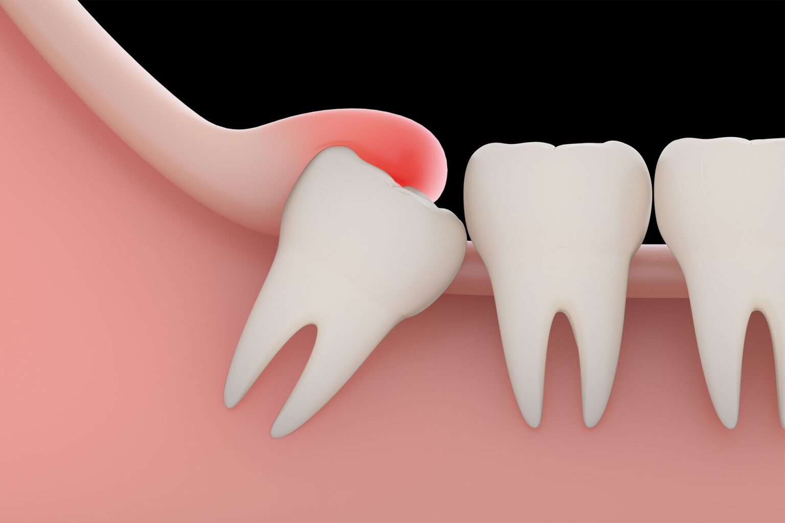 What Happens If You Leave A Wisdom Tooth Infection Untreated? - Health ...