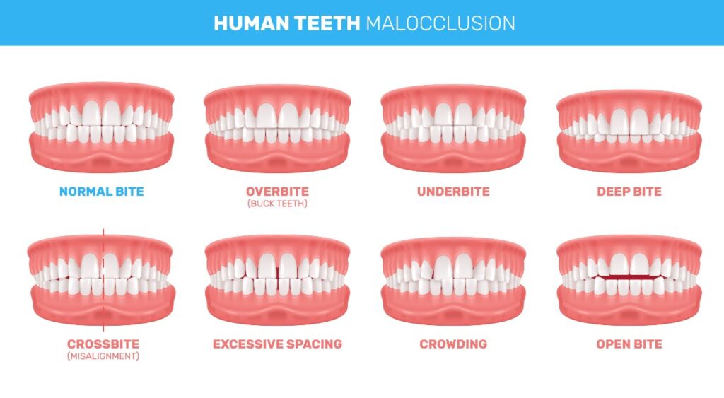 What Causes a Misaligned Jaw? - Health Care Reform