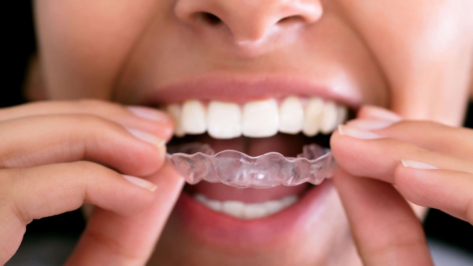 The Ultimate Guide to Treating Teeth Grinding: Tips and Tricks for a ...