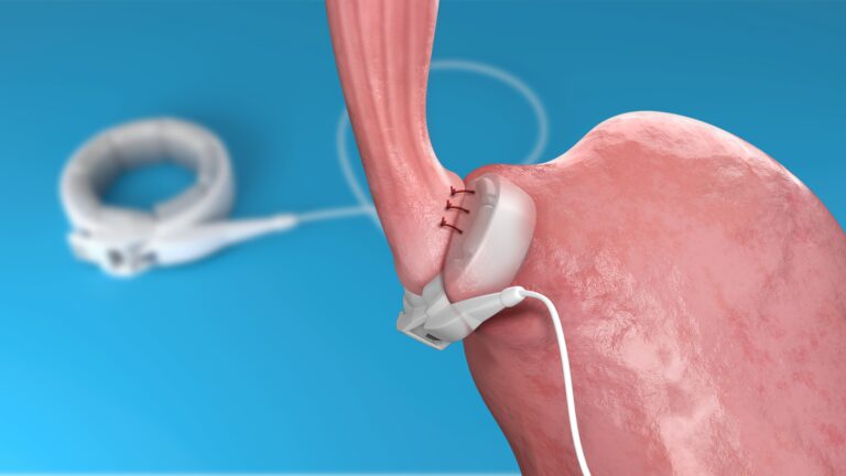 Lap band Surgery: Who can get it & How Much Does it Cost? - Health Care ...
